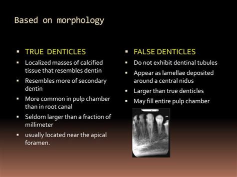 Pulp Calcification Pptx Dental Health Diseases And Conditions