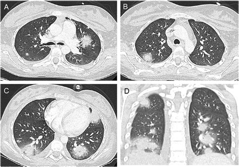 Baseline Contrast Enhanced Chest Computed Tomography Ct Baseline