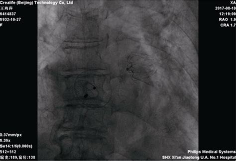 A 27 Mm Watchman Device And A 20 Mm Amplatzer Atrial Septal Defect Download Scientific Diagram
