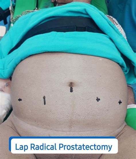 Laparoscopic Radical Prostatectomy With Anterior Hood Technique