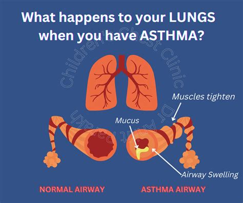 What Happens To Your Lungs When You Have Asthma Dr Ankit Parakh Indias Best Pediatric