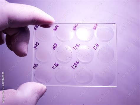 Rpr Vdrl Syphilis Test Glass Slide Agglutination Method Showing Reactive And Nonreactive