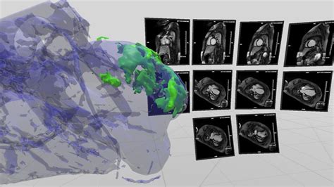 3d Visualization Of Myocardial Scar Youtube