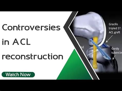 ACL Reconstruction Video MEDtube Net