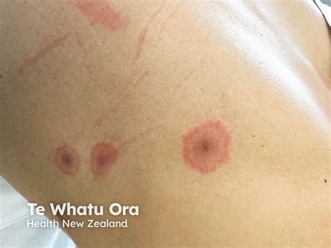 Reactive Infectious Mucocutaneous Eruption Images