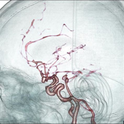 Mca And Basilar Tip Aneurysms Image