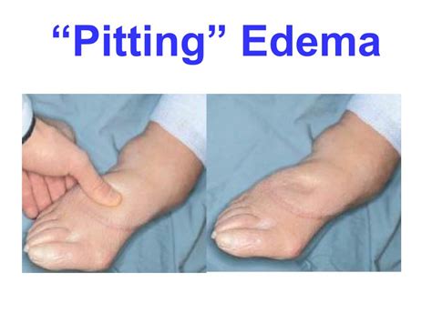 Ppt Hemodynamic Disorders Powerpoint Presentation Free Download Id4307841