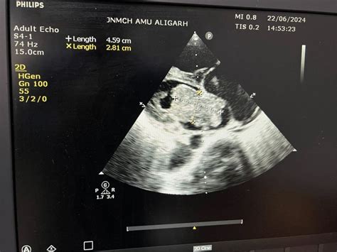 Mohammad Saquib Alam On Linkedin Cardiology Echo Casereport
