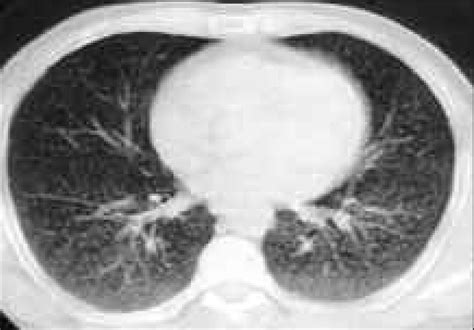 Multiple Centrilobular Nodules Throughout Both Lung Fields With No Download Scientific Diagram