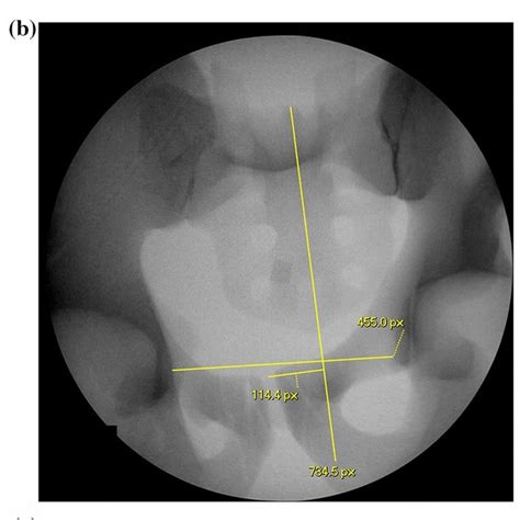 A Standard Anteroposterior Ap Pelvis Fluoroscopy Image Illustrating Download Scientific