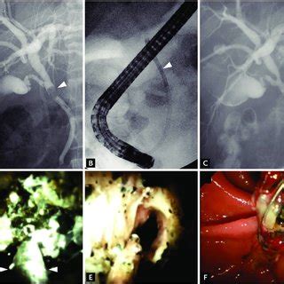 Single Operator Cholangioscopy SOC Guided Electrohydraulic Download Scientific Diagram
