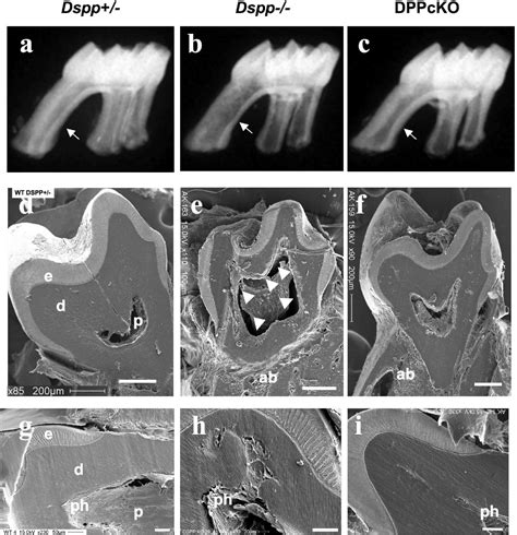 Dentinogenesis Imperfecta Semantic Scholar