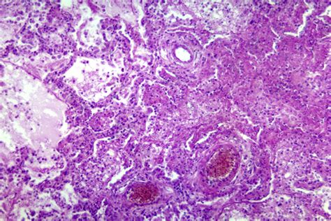 Free Picture Histopathology Toxoplasmosis Lung Complication