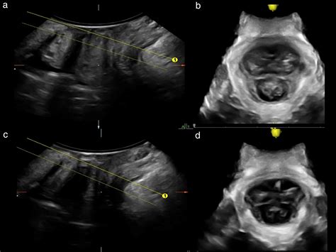 Pelvic Floor Muscle Dysfunction On 3d 4d Transperineal Ultrasound In