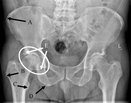 Fracture Of A Patellar Enthesophyte Bmj Case Reports
