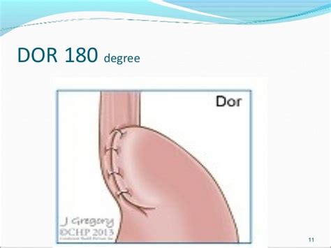 Fundoplication And Hellers Myotomy