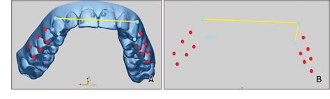 [pdf] Clinical Expression Of Programmed Maxillary Buccal Expansion And Buccolingual Crown