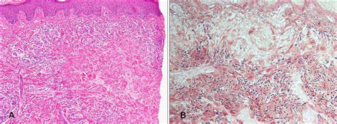 Anetoderma Developing In Generalized Granuloma Annulare In An Infant