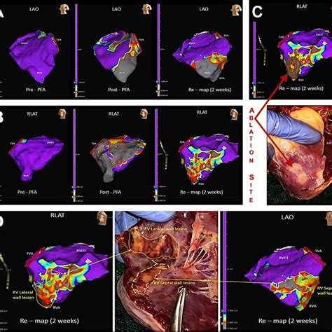 3d Mapping Assessment Of The Ablation Lesions Created Using The Linear Download Scientific