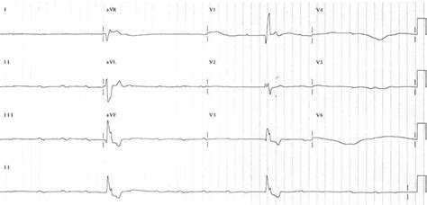 What Is 3rd Degree Heart Block Free Word Template
