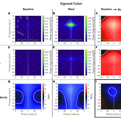 1 H Examples Of High Resolution Colonic Manometry Traces Recorded In