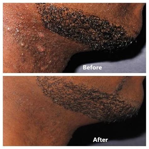 Pseudofolliculitis Barbae Treatment Lancaster Pa Razor Bump Relief