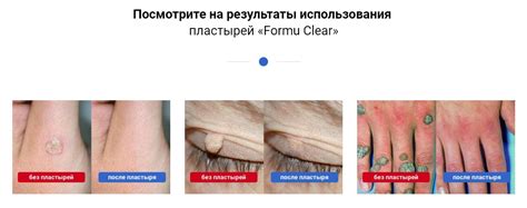 Formu Clear пластыри от папиллом (15 фото): купить, цена, отзывы, обзор