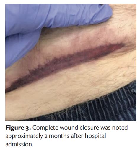 Use Of Negative Pressure Wound Therapy To Successfully Treat