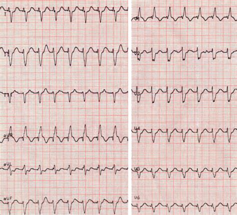 Ventricular Tachycardia Vt Ecg