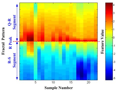Fpga Implementation Of Fractal Patterns Classifier For Multiple Cardiac Arrhythmias Detection