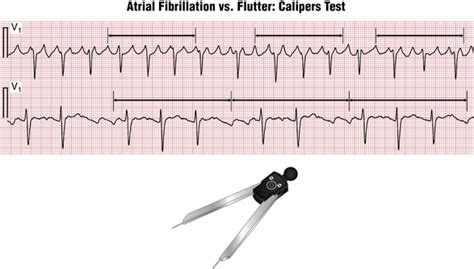 Atrial Flutter Sawtooth Ecg