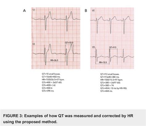 Figure 3 From A Practical Method For Qtc Interval Measurement