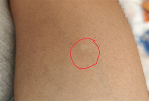Hypopigmented Patch Rdermatologyquestions