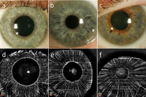 Anterior Segment Optical Coherence Tomography Angiography For Identification Of Iris Vasculature