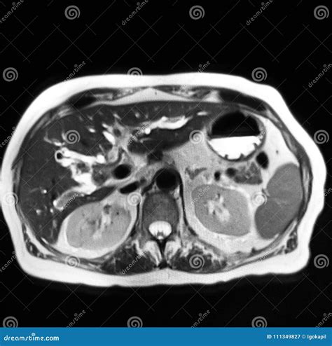 Cholangiogram Gallbladder Stones Cholecystosis Mri Royalty Free Stock