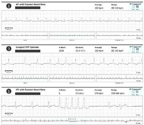 Difference Between Svt And Afib