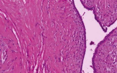 Fibroepithelial Lesions Clinical Tree
