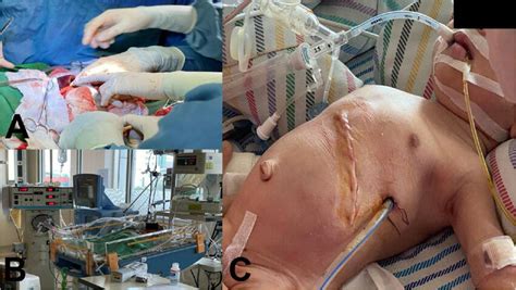 A Cdh Operation Procedure B Hfo Ventilation After Surgery And C