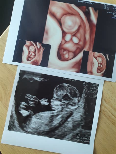 임신 12주 봄빛병원 1차 정밀초음파 기형아검사목투명대 피검사 네이버 블로그