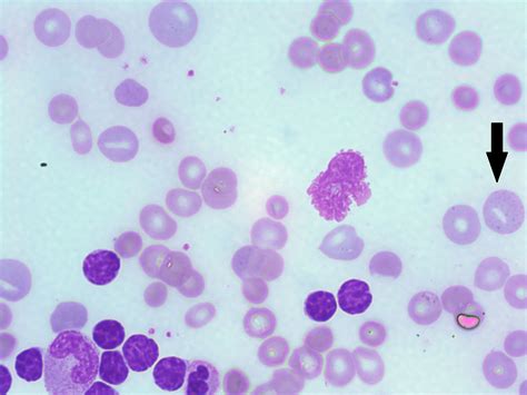 Basophilic Stippling Basophilic Stippling Of Erythrocytes In