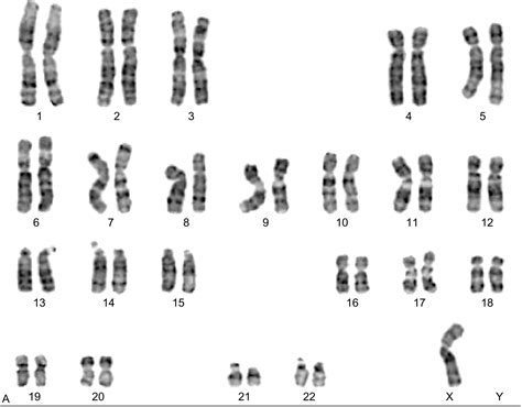 Turner Syndrome Clinical Tree