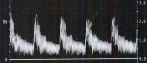Hemodynamics Flashcards Quizlet