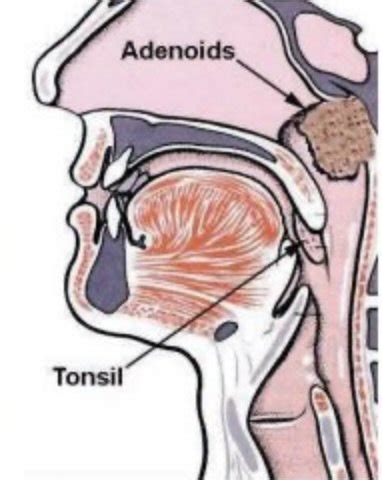 Enlarged Adenoids And Tonsils — Primitive Breathing