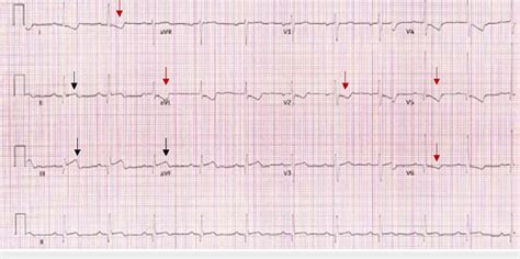 Ekg Showing Inferior Stemi Ekg Showing St Segment Elevation In Leads Download Scientific