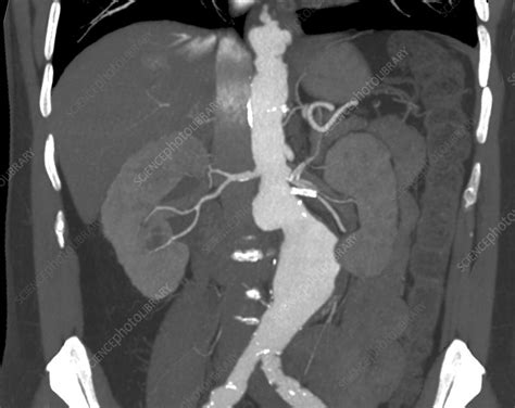 Abdominal Aortic Aneurysm Ct Scan Stock Image C048 7383 Science Photo Library