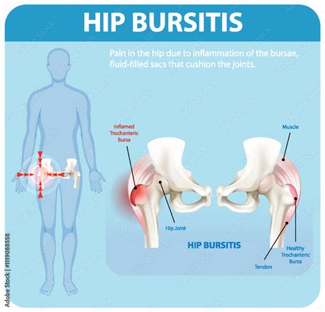 Understanding Hip Bursitis And Its Effects Stock Vector Adobe Stock