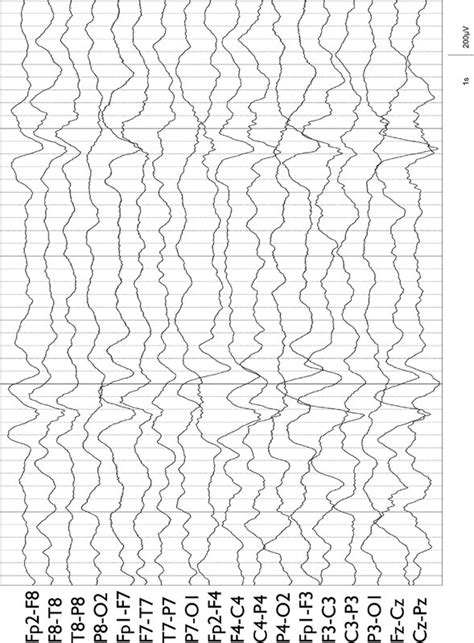 Electroencephalography With Generalized Slowing And Periodic Pattern