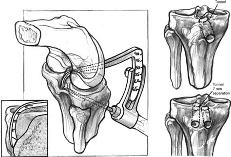 Posterior Cruciate Ligament Reconstruction All Inside Arthroscopic Technique And Tibial Inlay