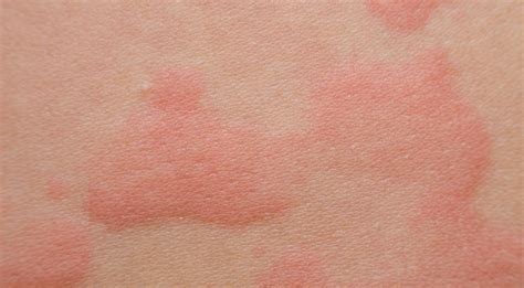 Dermatitis Numularis Gejala Penyebab Dan Pengobatan Halodoc