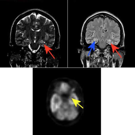 Mesial Temporal Sclerosis Docneuro